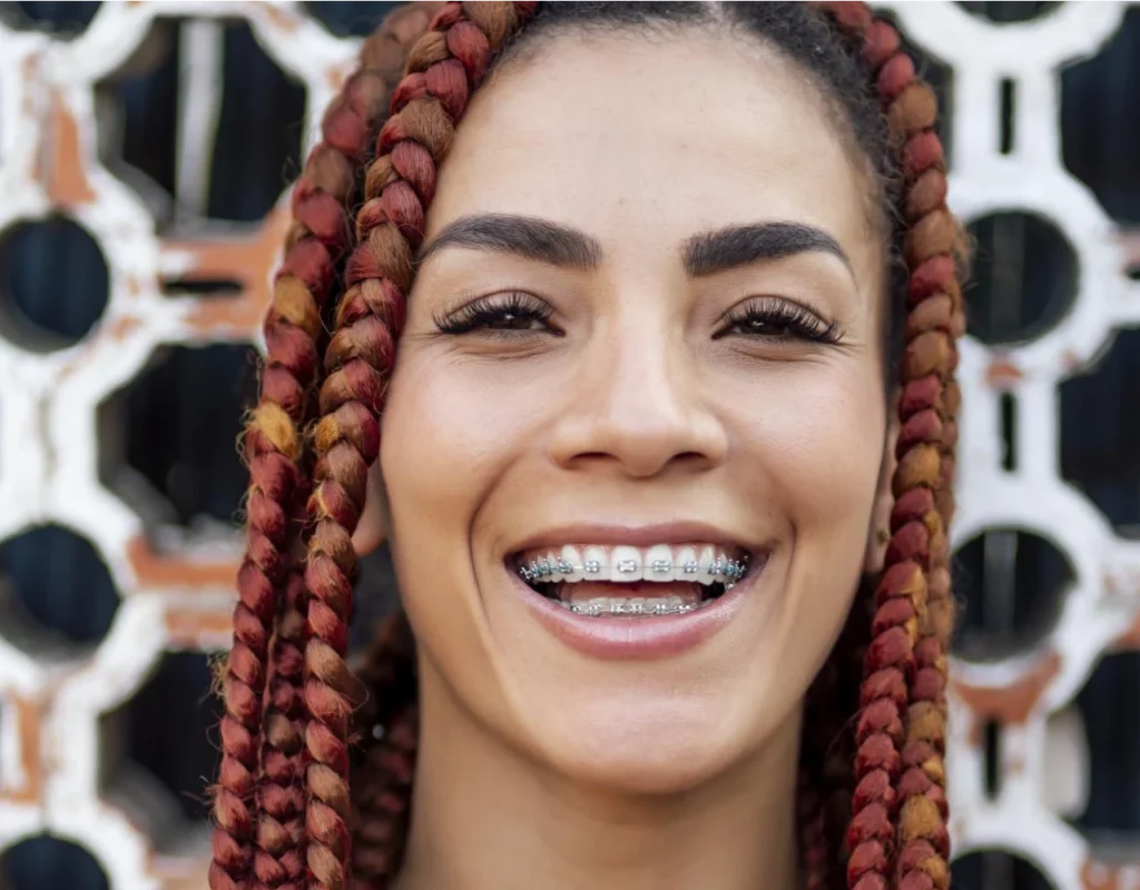 Aparelho Estético Autoligado: Preço E Mais Dicas.